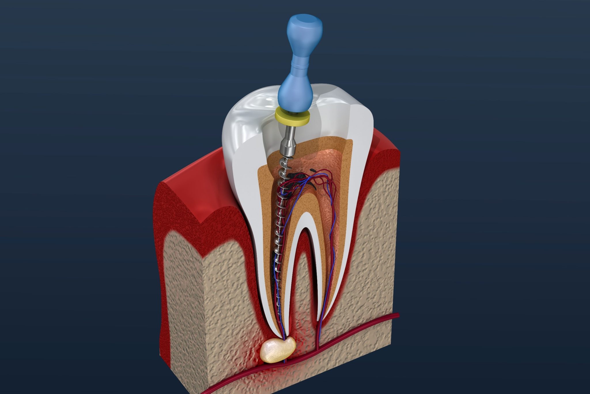 Get the Facts About Root Canal Recovery